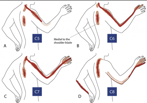 9 Facts About SICK Scapula That May Surprise You - Performance Place ...